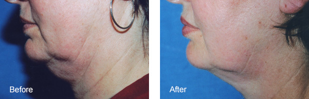 SkinTyte & Titan in Porter Ranch | Nu Vela Laser Medical Spa